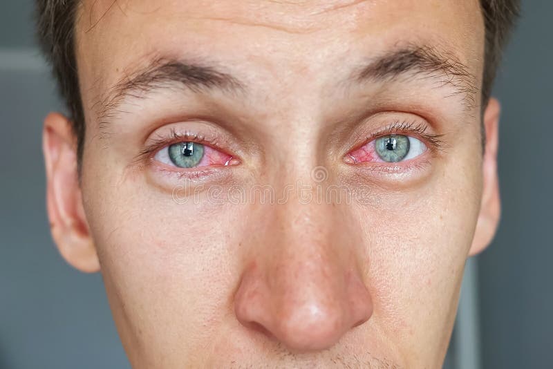 Young Man with Red Eyes Looking at the Camera Stock Image - Image of ...