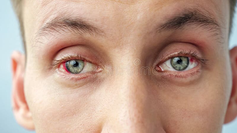 Young Man with Red Eyes Looking at the Camera Stock Image - Image of ...
