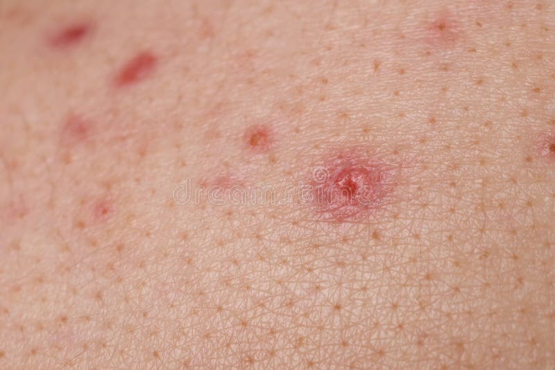 Young Person with Acne Problem, Closeup View of Skin Stock Image ...