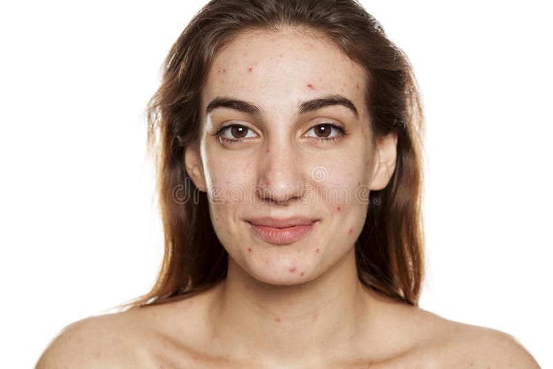 Problematic skin stock photo. Image of facial, beauty - 120024160
