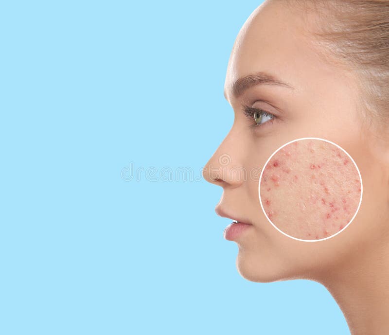 Young Woman with Acne Problem on Blue Background. Space for Text Stock ...