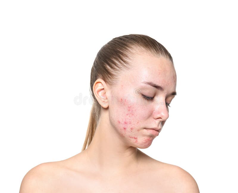 Beautiful Brunette Girl with Problem Skin. Acne and Redness on the Skin ...
