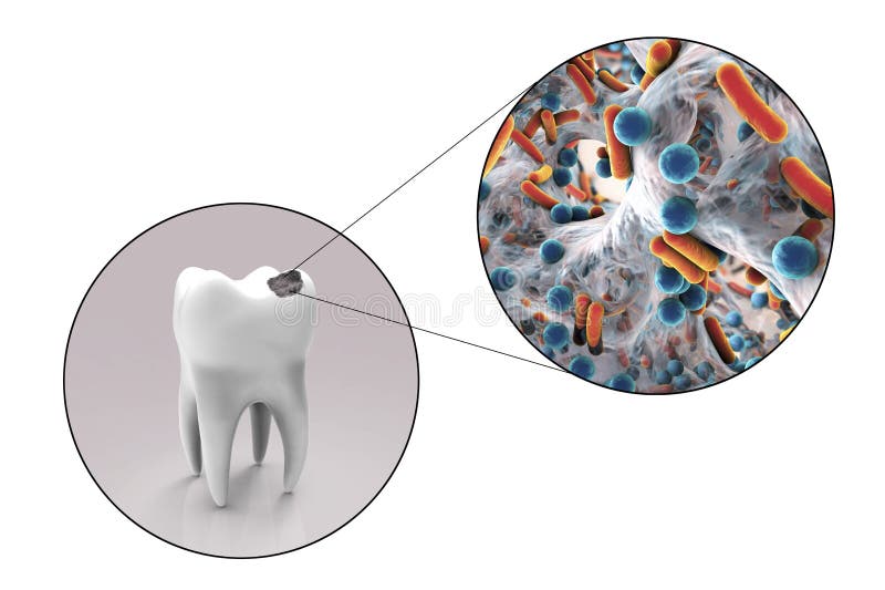 Zahn Mit Zahnmedizinischer Karies Stock Abbildung - Illustration von ...