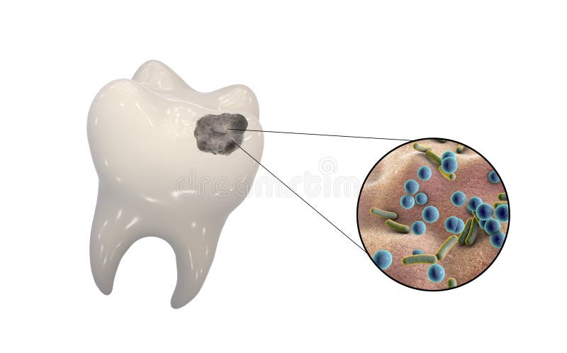 Zahn Mit Zahnmedizinischer Karies Stock Abbildung - Illustration von ...