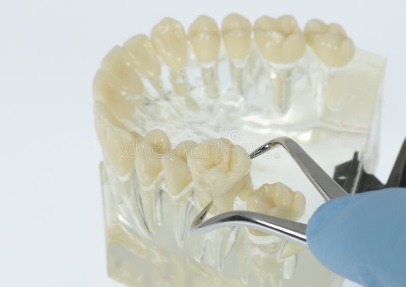 Ziehen eines Zahnes stockfoto. Bild von backenzahn, ziehen - 35138224