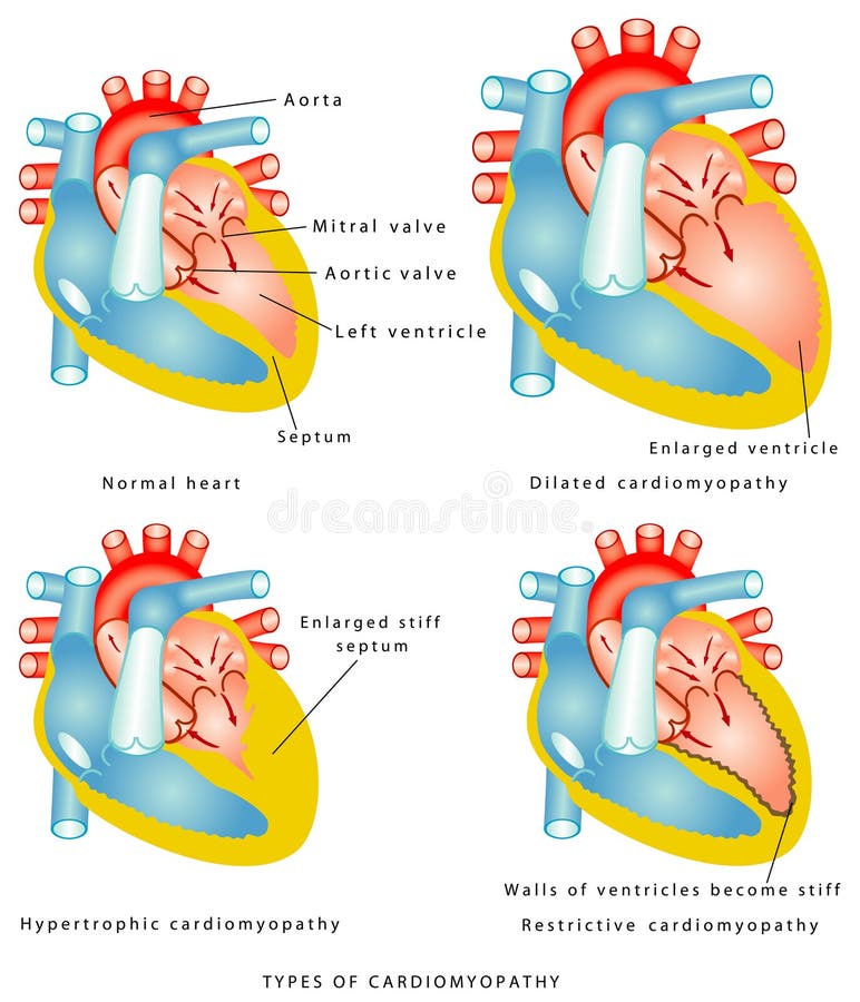 Ziekten van de Hartspier vector illustratie. Illustration of aorta ...
