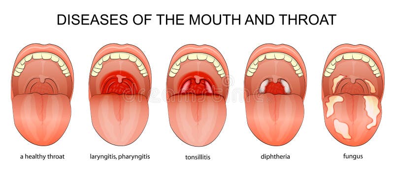 Strep Keel Virus Diagram Droevige Vrouw Met Een Pijn In Keel Symptoom