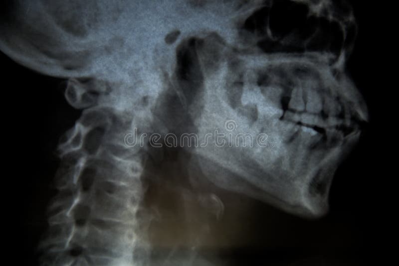 Zijde Van De Film X-ray Schedel Stock Afbeelding - Image of been ...