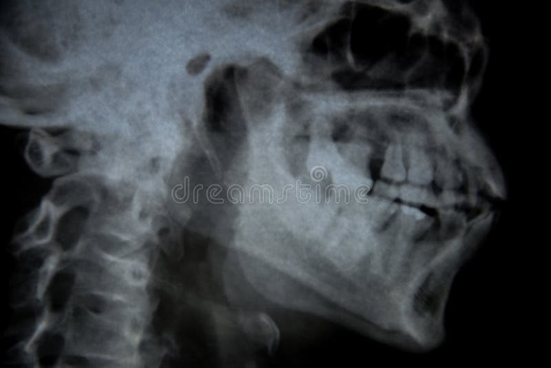 Zijde Van De Film X-ray Schedel Stock Foto - Image of been, anatomie ...