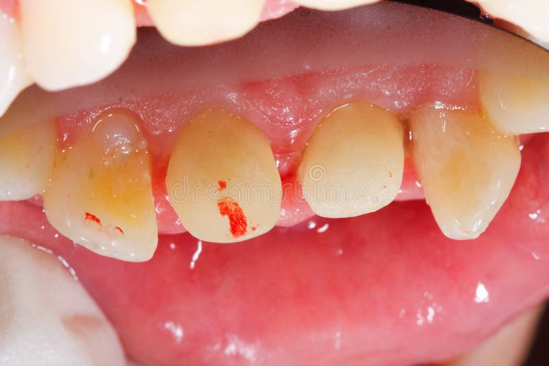 Dental Stub for Crown with Retraction Thread Stock Photo - Image of ...