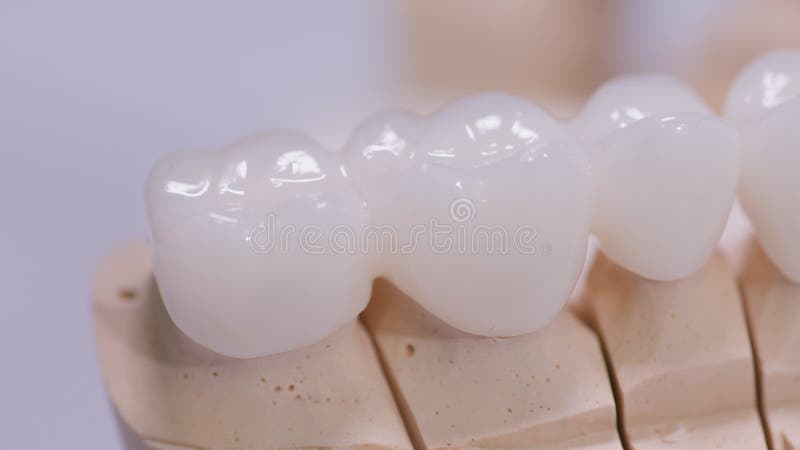 Ceramic Teeth with the Implant on a Plaster Model Isolated on a White ...
