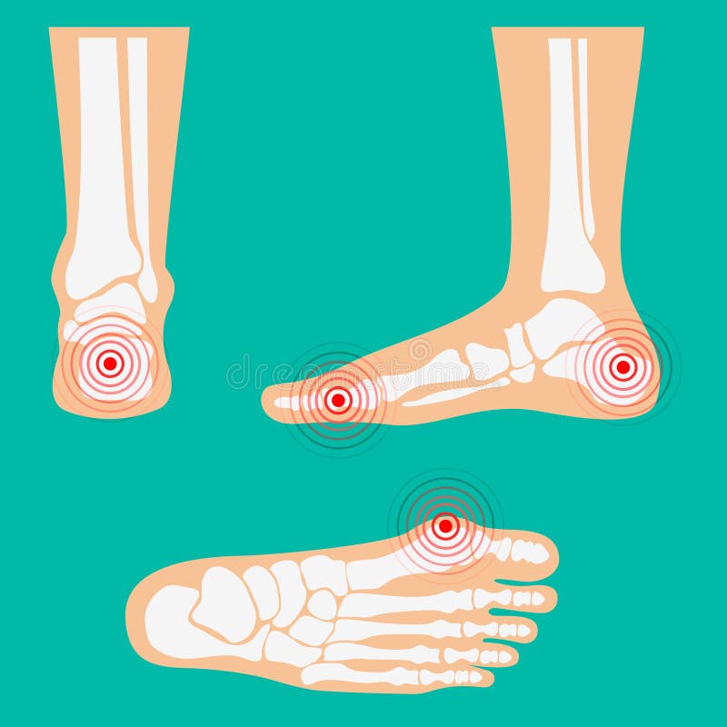 Jeu De Cible Rouge Douloureux. Cercles De Douleur. Ondes Soniques ...