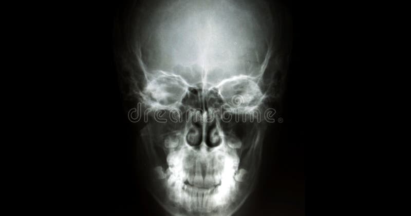Zoom-in X-ray of a Human Skull, Human Bones. Stock Footage - Video of ...
