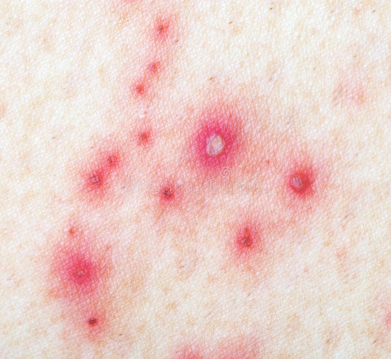 629 Herpes Zoster Fotos de stock - Fotos libres de regalías de Dreamstime