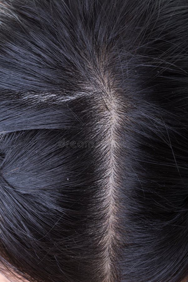 Zwart Haar Met Hoofdroos Op Hoofd Stock Foto - Image of medisch ...