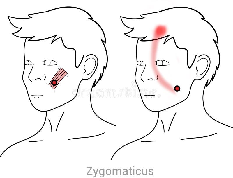 Zygomaticus: Managing Pain Arriving from Myofascial Trigger Points in ...