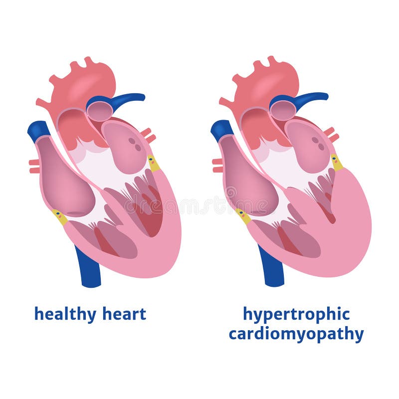 Hypertrophic Cardiomyopathy Occurs When The Muscle Cells Of The Heart