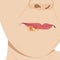 Herpes Simplex Virus or HSV on the Lip Close-up Illustration Stock ...