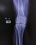 X-ray of Knee Joint Side View. Normal Joint and Space, Medical Image ...