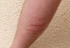 Abrasion Wound Stock Photos, Images, & Pictures - 216 Images