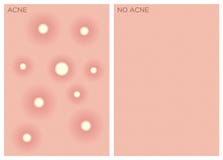 Acne Skin Texture Royalty Free Stock Image - Image: 12499106