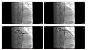 Angiogram Of Leg Vessels, Both Calf Royalty Free Stock Photography ...