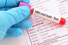 Hepatitis B Virus (HBV) Blood Sample Stock Image - Image of illness ...