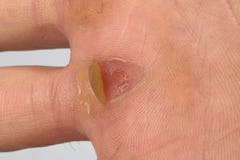 Palm With Calluses. Hard Work Concept. Blisters On The Injured Hand ...