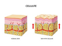 Cellulite and normal skin stock vector. Illustration of cellulite ...