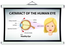Cataract Eye Stock Images - Image: 33642464