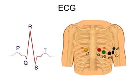 Chest Ecg Leads Placement Illustration. Six Colored Electrocardiography ...