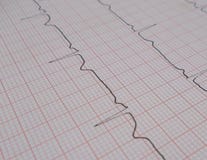 Electrocardiograma Sano Del Corazón Foto de archivo - Imagen de pulso ...