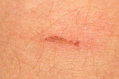 Ferida Na Pele De Uma Pessoa Foto de Stock - Imagem de médico, saúde ...