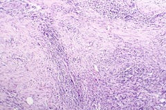 Histopathology Of Chronic Appendicitis Stock Image - Image of pathology ...