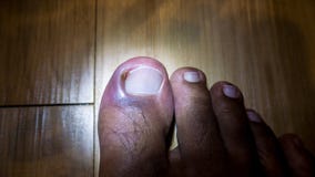 Ingrown toenail stock photo. Image of felon, disease - 33306364