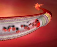 Kransslagaders En Plaque-vorming Stock Afbeelding - Afbeelding: 12493641