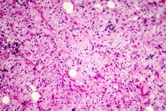 Liposarcoma, Soft Tissue Sarcoma Stock Image - Image of histology ...