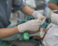 Anesthesia Nurse Use Suction Suck Sputum In Double Lumen Endotracheal ...