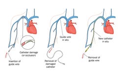 Peripherally Inserted Central Catheter (PICC) Stock Vector ...