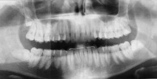 Quijada Humana Imagen de archivo - Imagen: 5468051