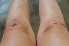 Knee Scratch Royalty Free Stock Image - Image: 17089686