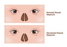 Setto Deviato Patologia Nasale Illustrazione di Stock - Illustrazione ...