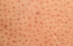 Dry Skin (ichthyosis) Detail Stock Image - Image of care, close: 51469743