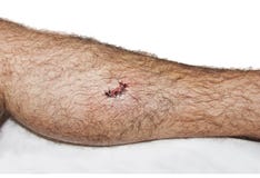 Wound healing stock vector. Illustration of anatomy, disease - 19023103