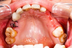 Stitches After Dental Extraction Stock Image - Image: 32450121