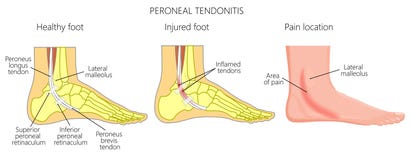 Tendões do pé ilustração do vetor. Ilustração de superior - 54203544