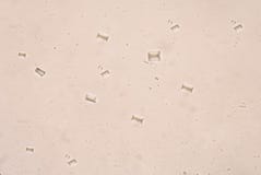 Triple Phosphate Crystals In Urine. Stock Image - Image of fluid ...