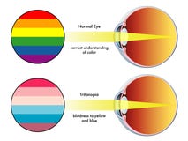 Protanopia stock vector. Illustration of genetic, visual - 27568119