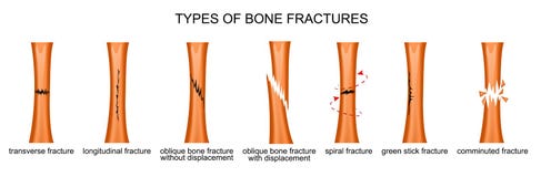 Typen der Knochenbrüche vektor abbildung. Illustration von abbildung ...