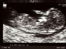 Uterus Stock Photos, Images, & Pictures - 1,281 Images